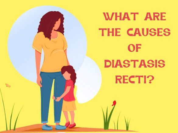 Dealing with Divarication of Recti: A First Time Mum Guide - otranation
